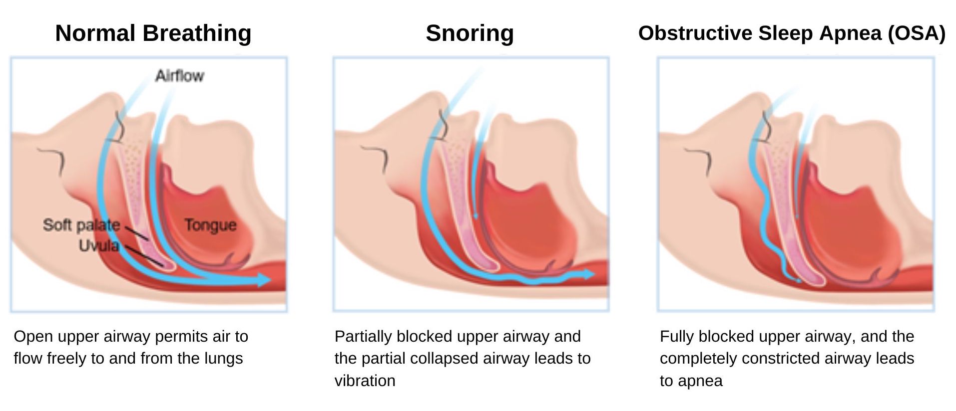 Understanding Snoring and Sleep Apnea - SOLVEMyHealth